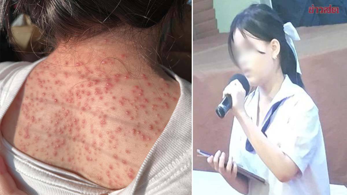 เปิดภาพ 'หยก' ผื่นขึ้นเต็มตัว คาดติดเชื้อหลังน้ำในบ้านปรานีไม่สะอาด | Khaosod | LINE TODAY