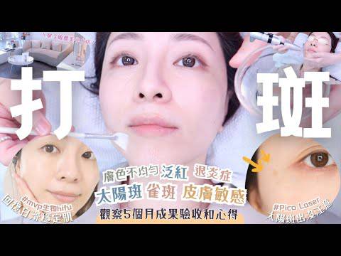 私分享打斑5個月後成果┃瑞士MVP生物療程抗敏效果超驚喜～♥┃單次收費小店及必買產品推介┃Katy Beauty | Katy Cheung ...