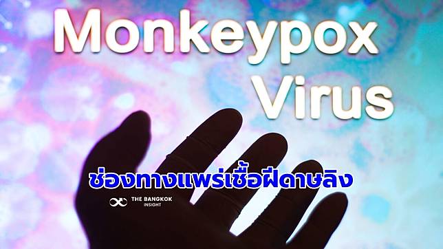 เข้าใจให้ถูก ‘ดร อนันต์ เตือน ‘ฝีดาษลิง ติดเชื้อได้หลายช่องทาง ไม่ใช่