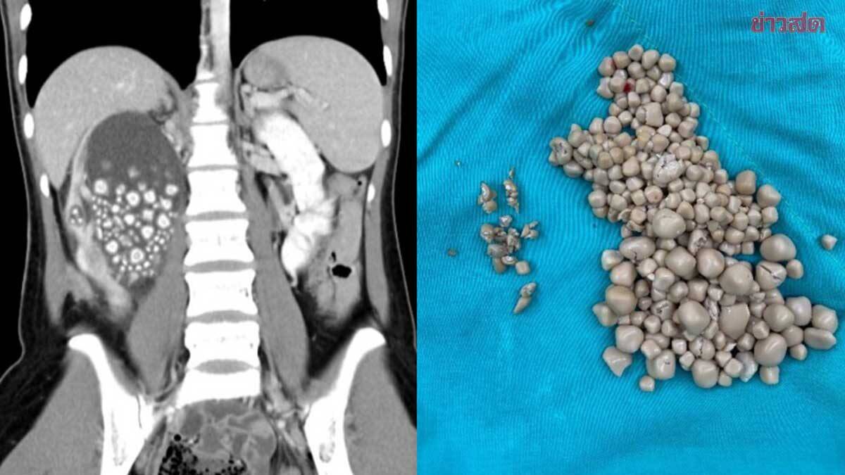 Shocking Medical Case: 20-year-old Taiwanese Woman Finds 300 Kidney ...