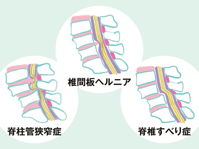 ぎっくり腰と慢性の腰痛はどこが違うの？脊柱管狭窄症・椎間板ヘルニア・脊椎すべり症をイラスト解説（ourage）
