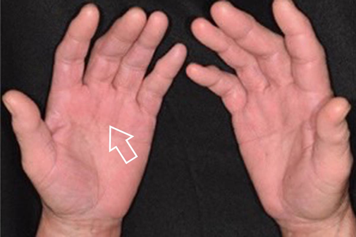 内臓の状態悪化は肌に出るーーその「首の黒ずみ」は胃がんかも！「この皮膚変化がヤバい症状」8（SmartFLASH）