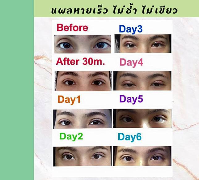 Akeru Feed | จัดอันดับ 5 คลินิกทำตาสองชั้นคุณภาพ ไม่ต้องไปไกลถึงเกาหลี