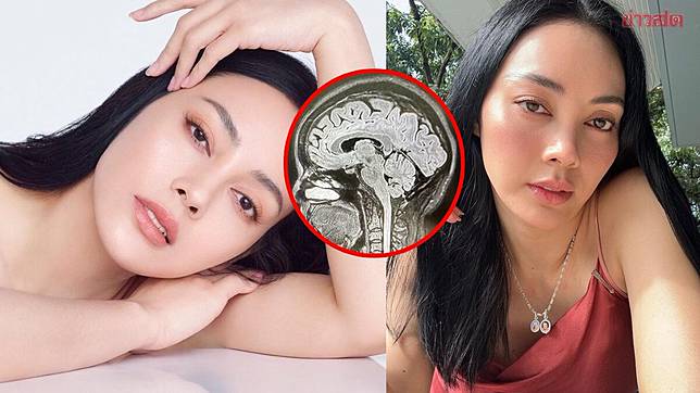 หวั่นเป็นโรคร้าย!! "ตั๊ก บงกช" รีบ MRI สมองด่วน หลังปวดหัวหนักมาก | Khaosod | LINE TODAY