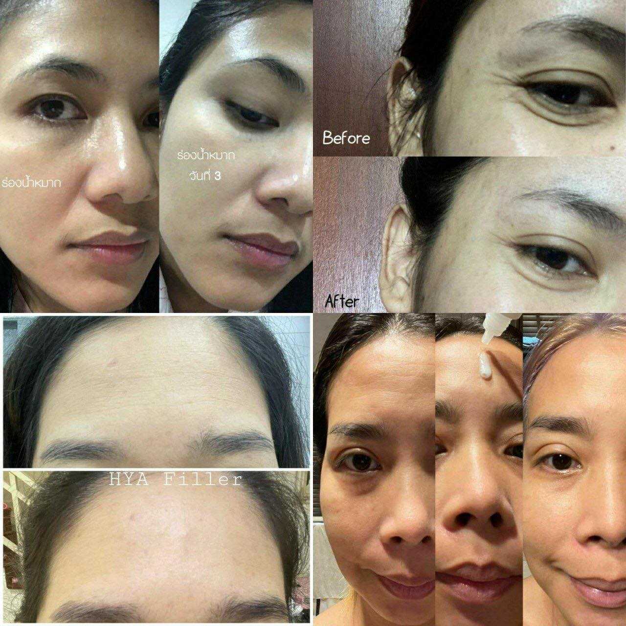 Hya filler ฟิลเลอร์แบบทา15ml 3ขวด 1,200 | LINE SHOPPING