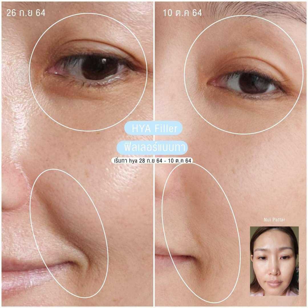 Hya filler ฟิลเลอร์แบบทา15ml 3ขวด 1,200 | LINE SHOPPING