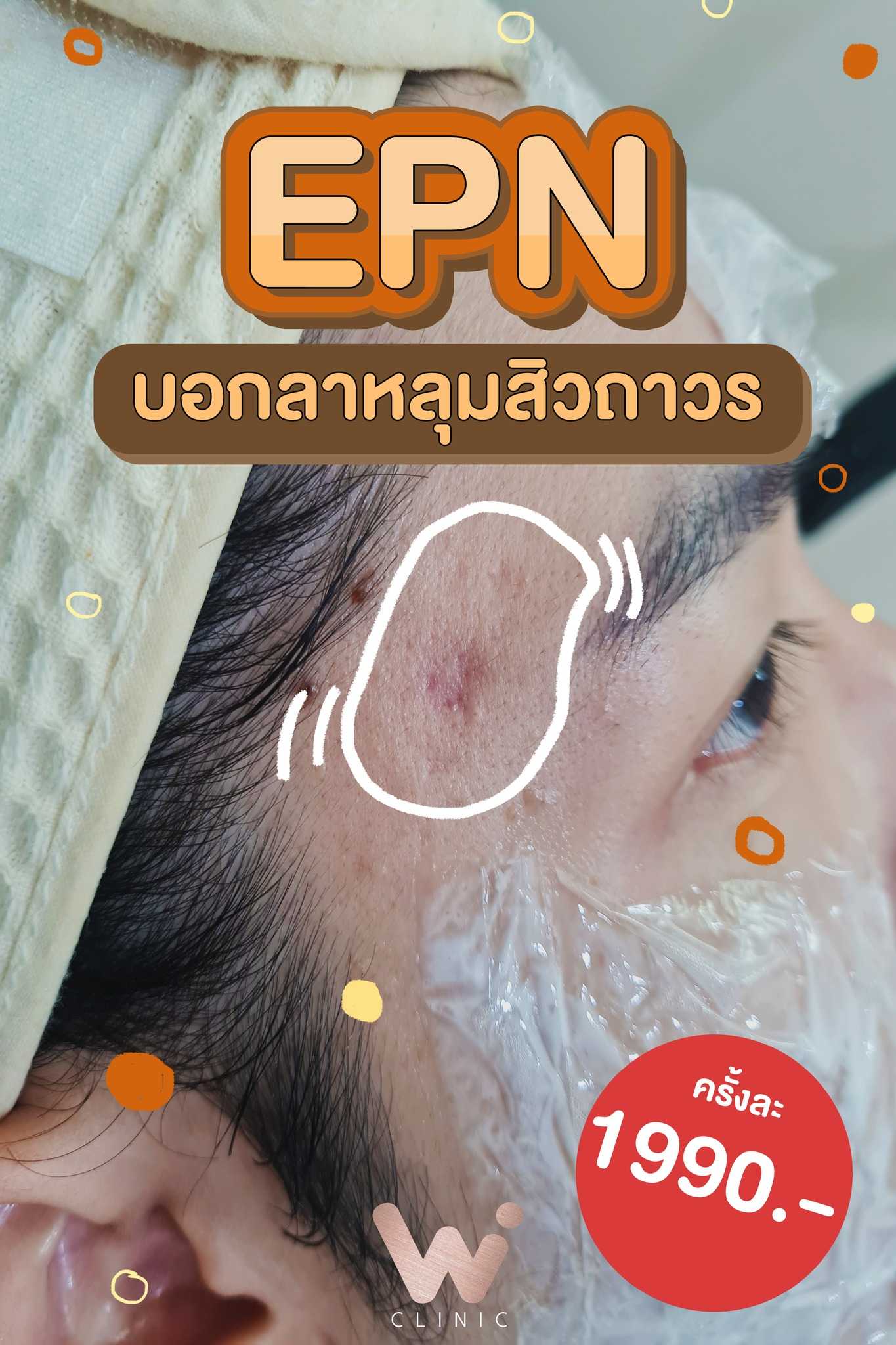 EPN รักษาหลุมสิว | LINE SHOPPING